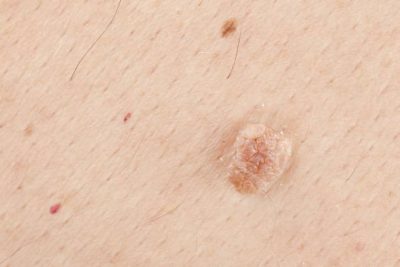 Understanding Warts and Verrucas: How HPV Plays a Major Role in Skin Health