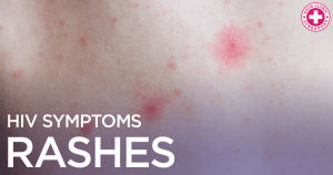 HIV Rash Singapore | HIV Rash | Shim Clinic